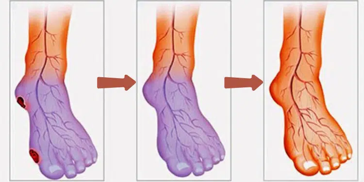 Cold Hands, Numb Legs? Therapist's 3 Remedies + 7 Secrets Fix Poor ...